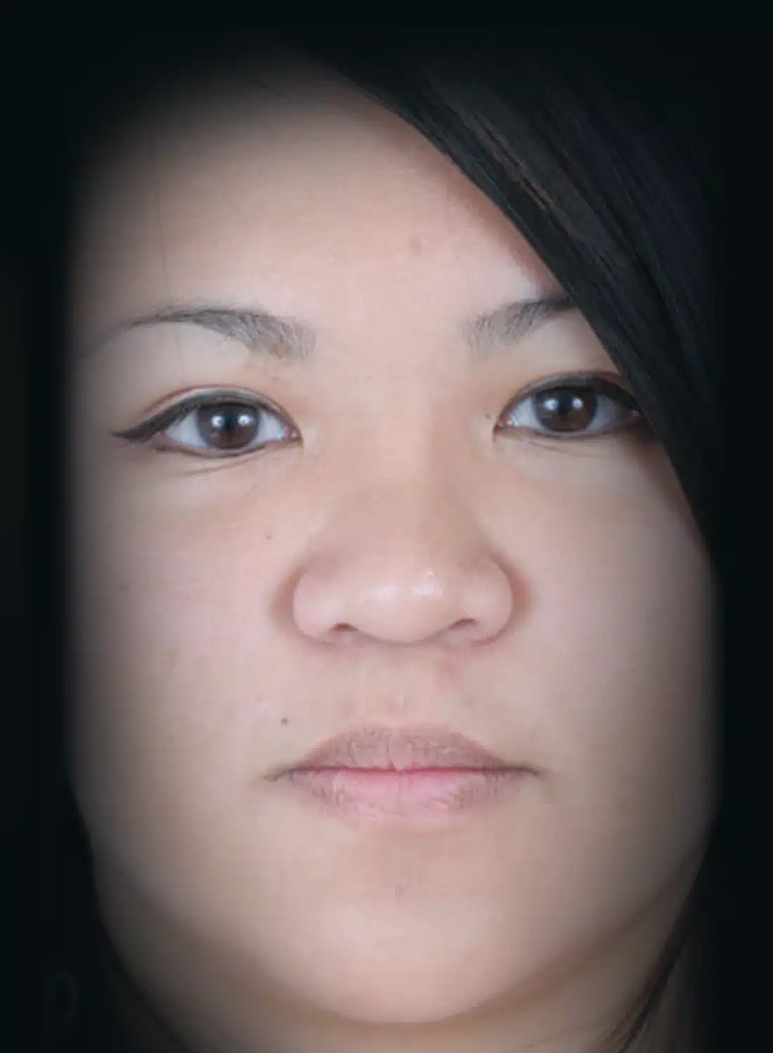 Crafting Natural Noses for Asian Patients | Noses and Necks NYC