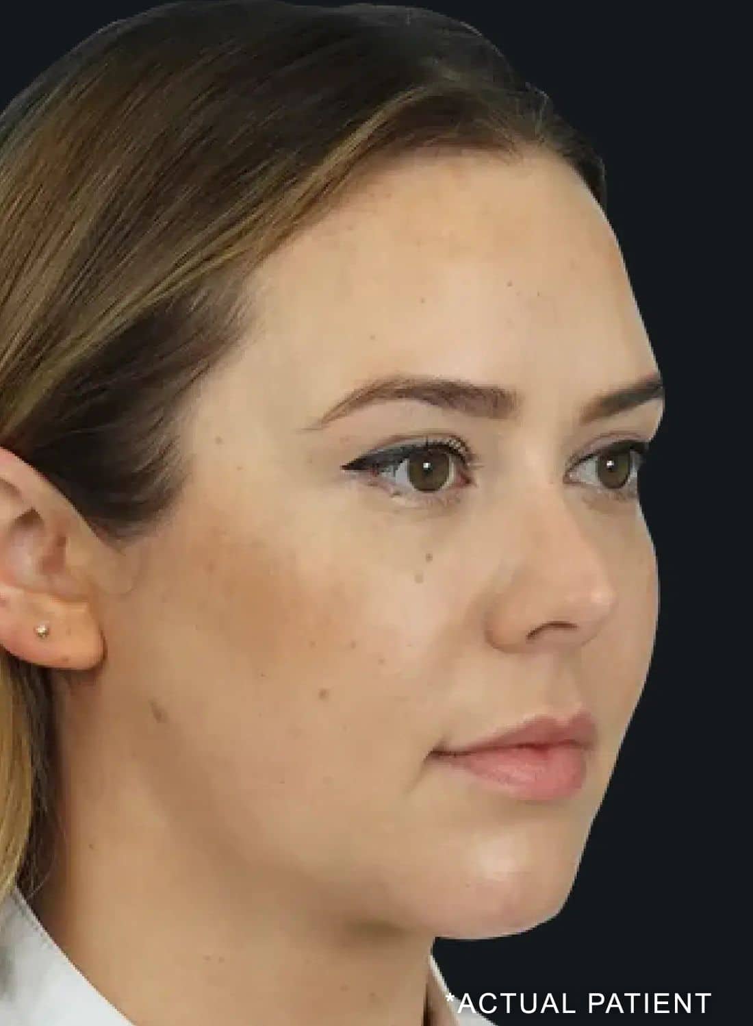 Facial Plastic Surgery by Dr. Anil Shah | Noses and Necks NYC
