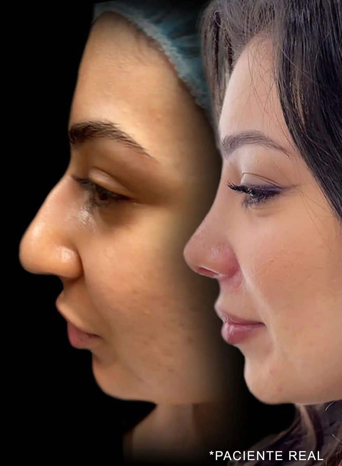 Rinoplastia por el Dr. Anil Shah | Noses and Necks NYC
